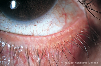 PRESENTACIÓN INTERACTIVA DE CASOS CLÍNICOS EN OPTOM 2016 - Veinte20